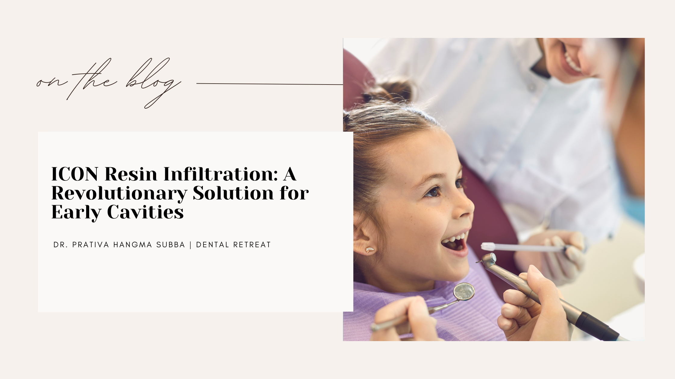 ICON Resin Infiltration: A Revolutionary Solution for Early Cavities